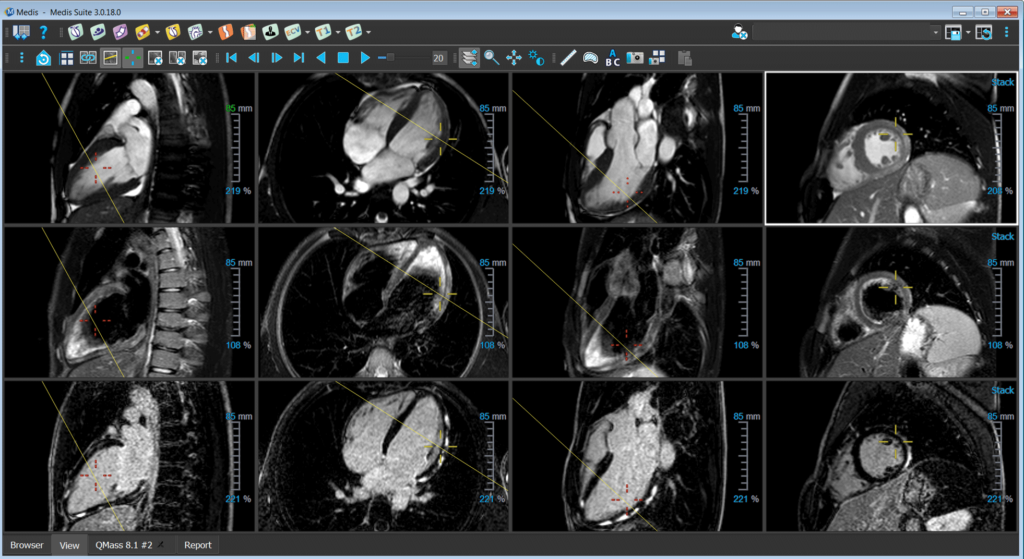 View_Acute_Myocarditis - medisimaging
