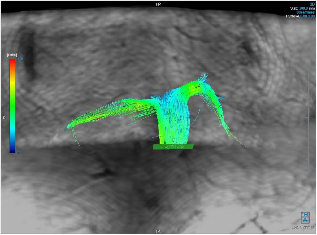3.-3D-Streamlines-4D-flow-PA-2 - medisimaging