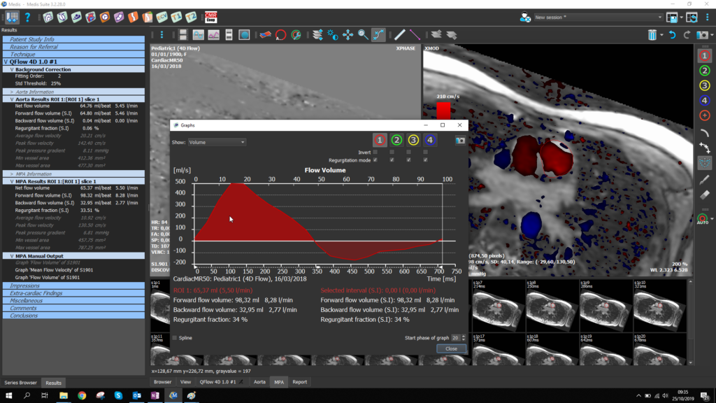 4d-flow-analysis - medisimaging