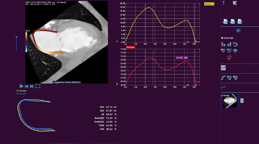 Atrial-strain-CT-big - medisimaging