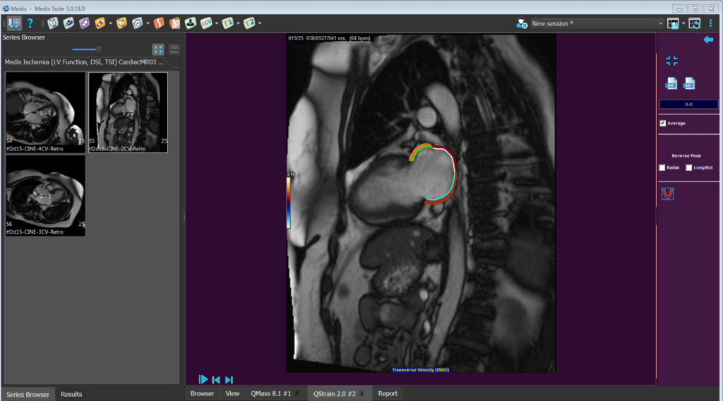 Atrial_Strain_3 - medisimaging