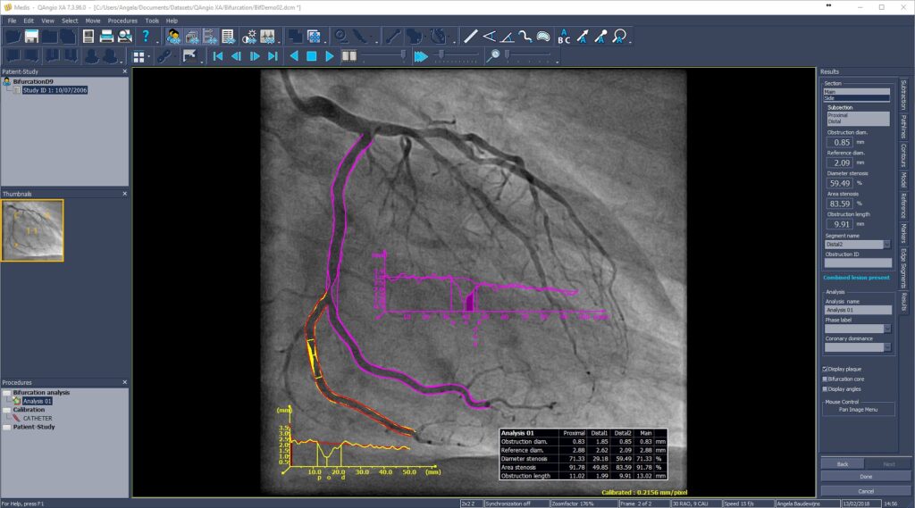 Bifurcation-T-shape-2 - medisimaging