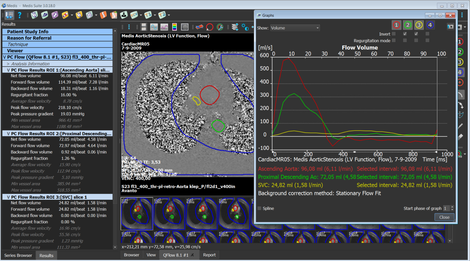 PCFlow_AorticStenosis - medisimaging