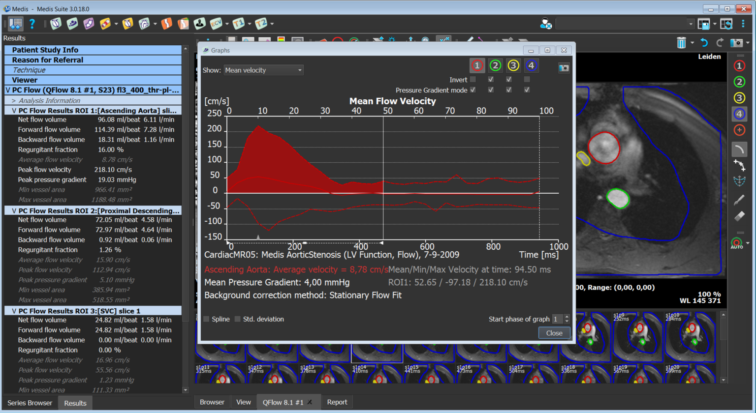 Medis Suite MR - Cardiac MRI - Medis Medical Imaging