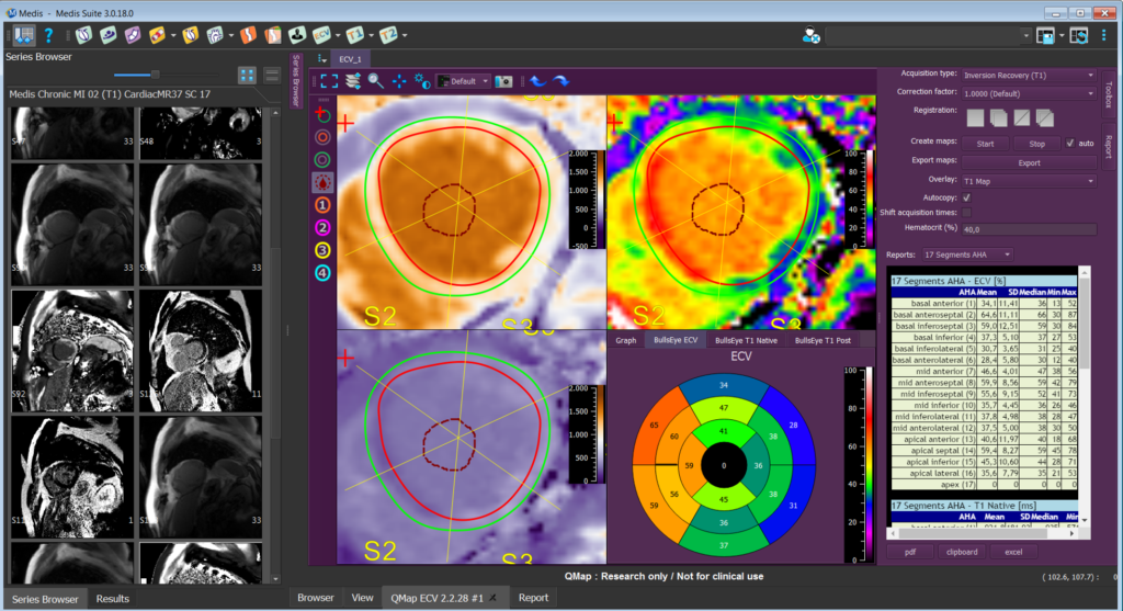 QMap_ECV_short_axis - medisimaging