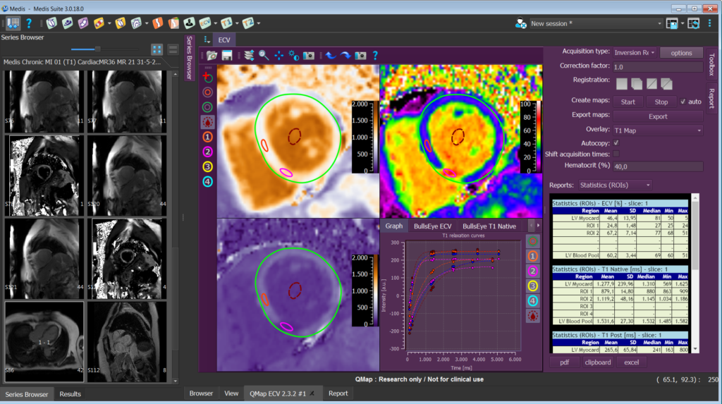 QMap_ECV_short_axis_2 - medisimaging