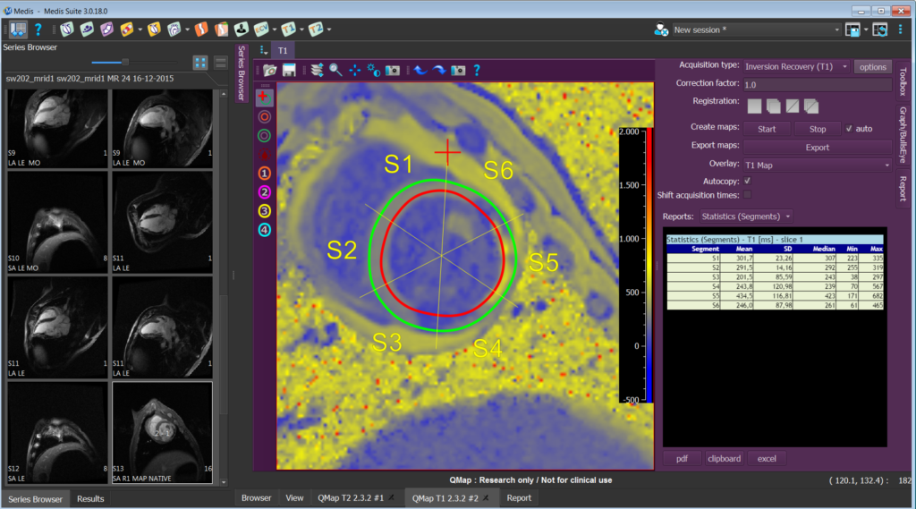 QMap_T1_AcuteMyocardialInfarction_short_axis - medisimaging