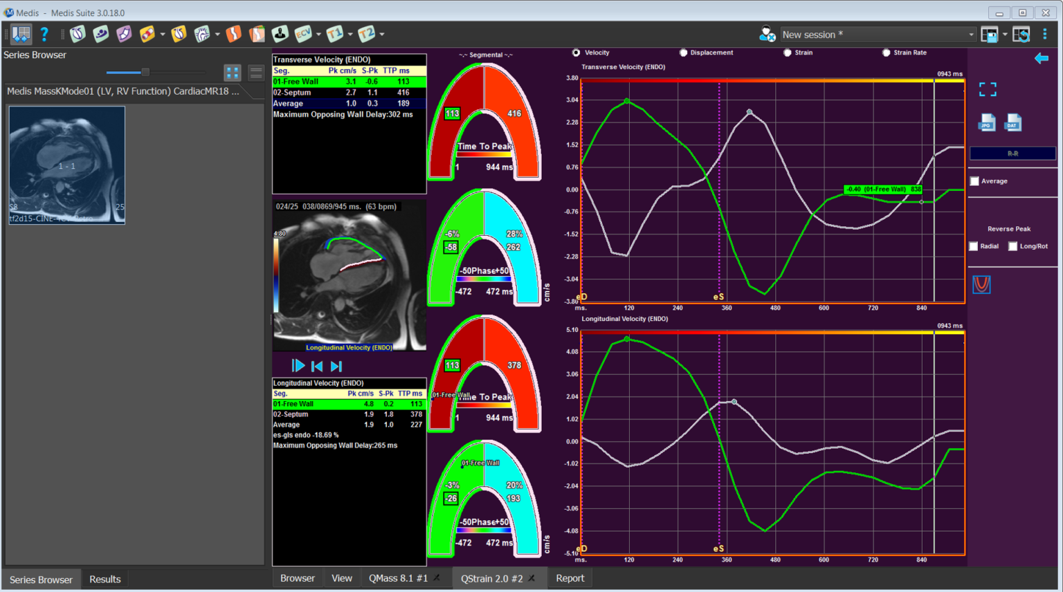 RV_Strain_3 - medisimaging