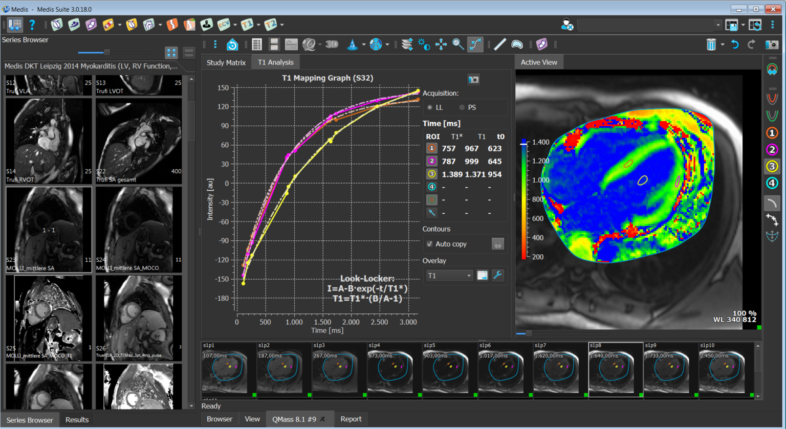 T1 Mapping Mapping - medisimaging