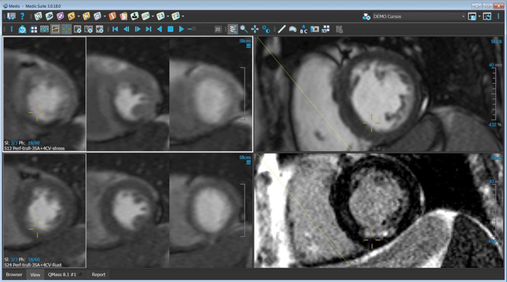 View_Stress_Induced_Ischemia - medisimaging