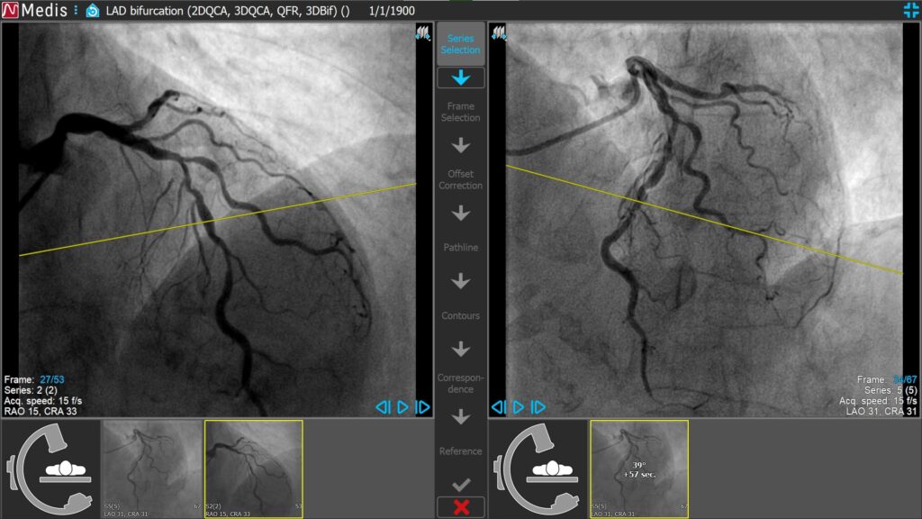Medis Suite XA - 3D QCA Single Vessel - medisimaging