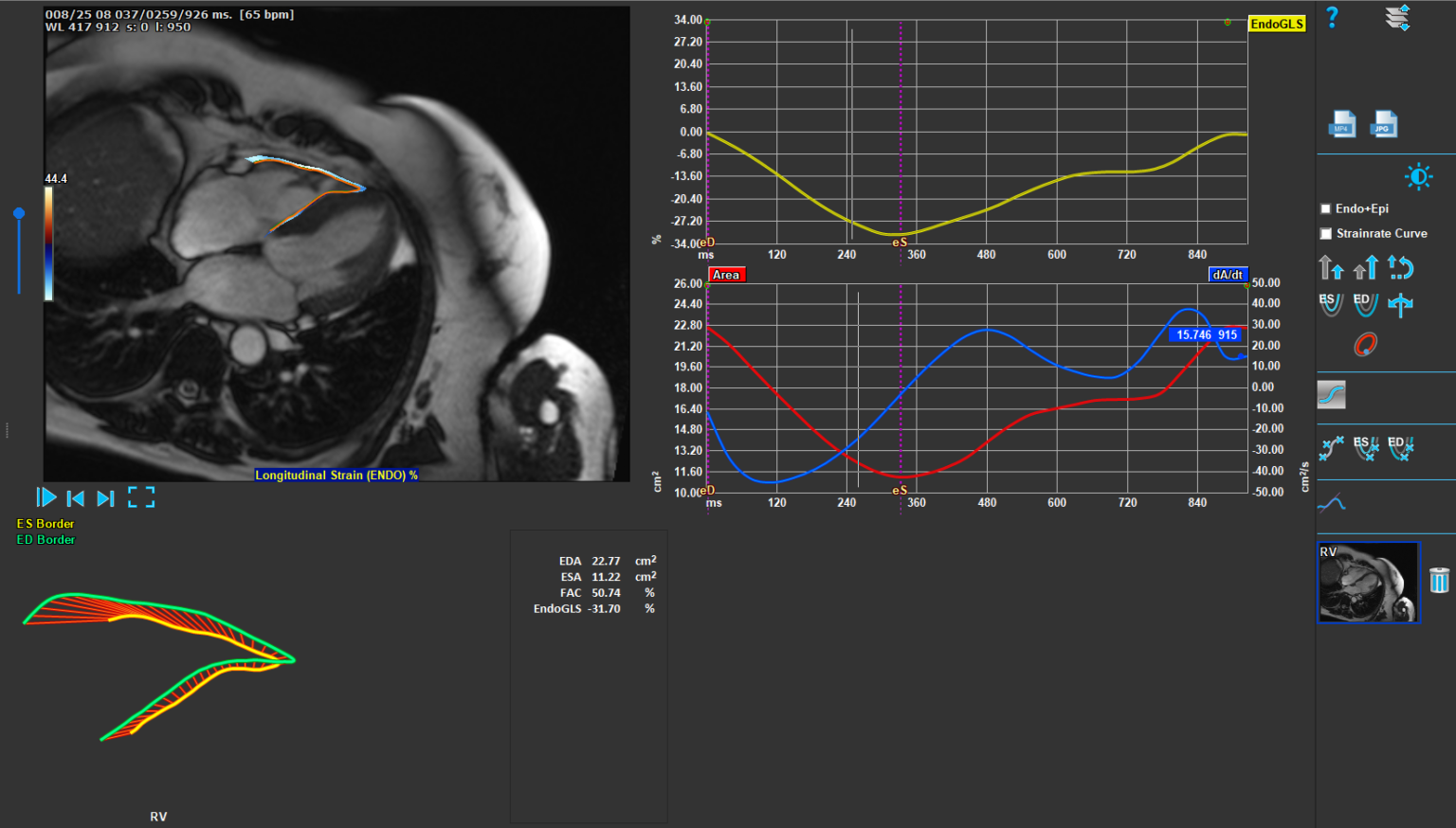 Cardiac function - MR - Cardiac Diagnostics made simple