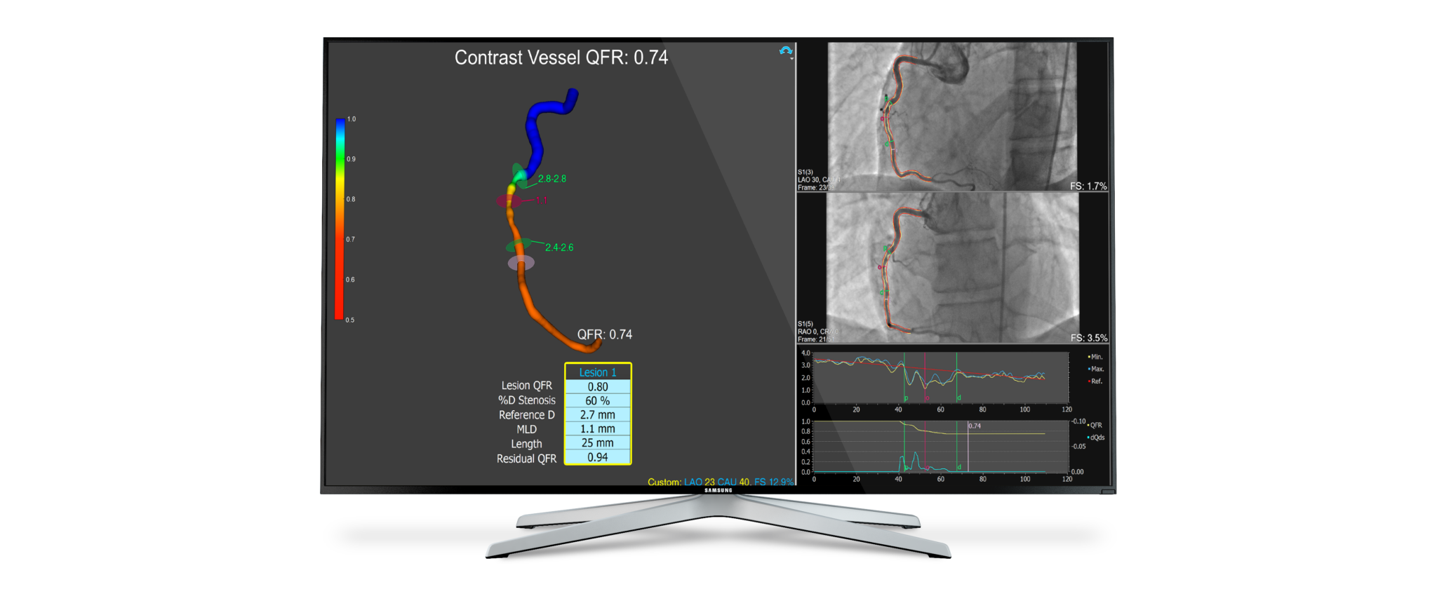 Medis QFR® - Physiology made simple